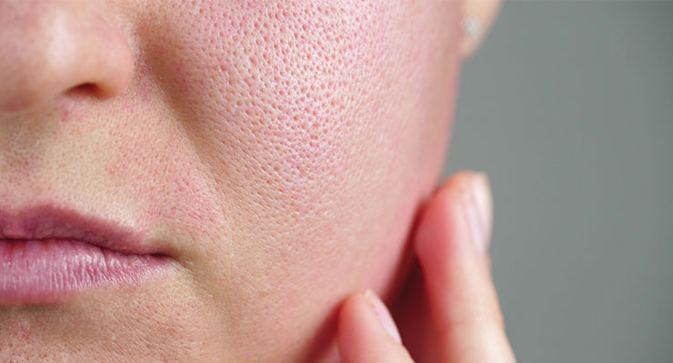 Two Novel Natural Extracts Improve Pore Appearance | Happi